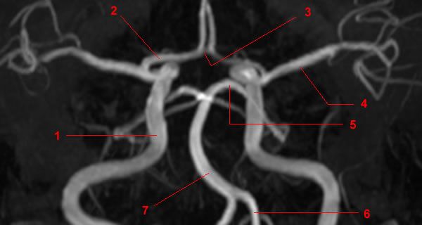 Circle Of Willis Angiogram