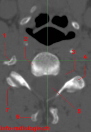 CT Scan of the Cervical Spine - W-Radiology