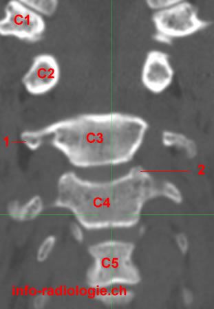 CT Scan of the Cervical Spine - W-Radiology