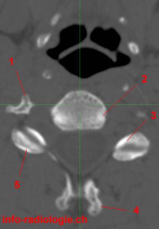 CT Scan of the Cervical Spine - W-Radiology