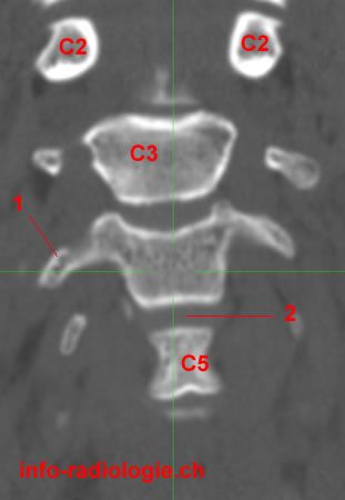 CT Scan of the Cervical Spine - W-Radiology