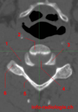 CT Scan of the Cervical Spine - W-Radiology