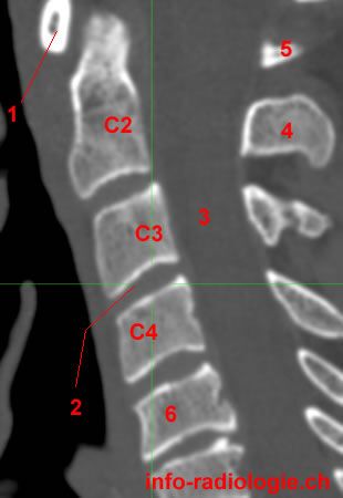 CT Scan of the Cervical Spine - W-Radiology