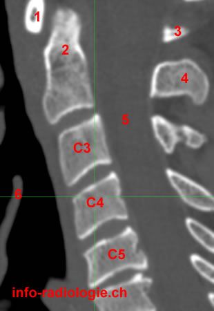 CT Scan of the Cervical Spine - W-Radiology