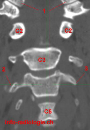 CT Scan of the Cervical Spine - W-Radiology