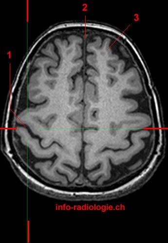 Central sulcus (fissure of Rolando) - W-Radiology