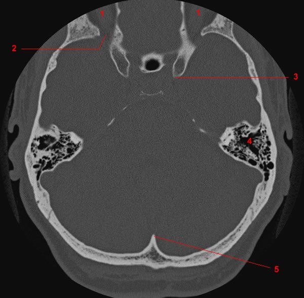foramina of the skull base (CT) - W-Radiology