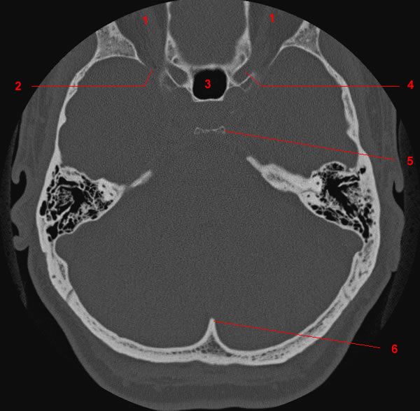 foramina of the skull base (CT) - W-Radiology