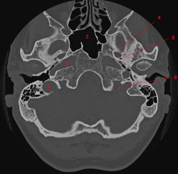 Skull Base Foramina Anatomy