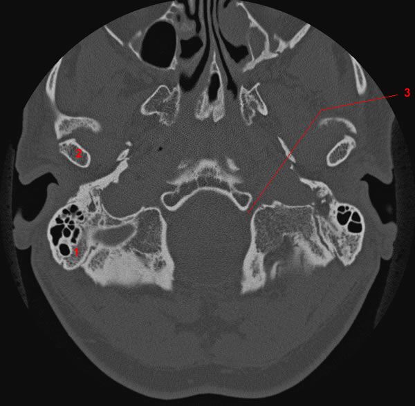 foramina of the skull base (CT) - W-Radiology