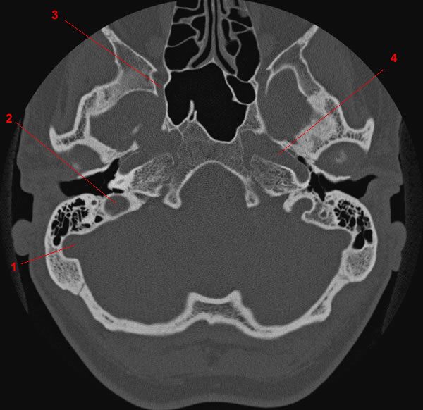 foramina of the skull base (CT) - W-Radiology