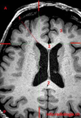 Lateral Ventricles - W-Radiology