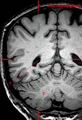 Lateral Ventricles - W-Radiology